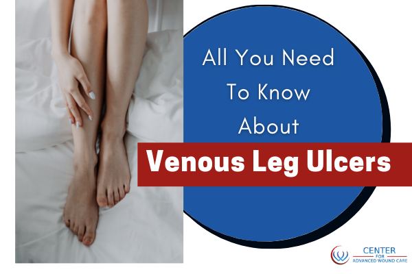 All You Need To Know About Venous Leg Ulcers